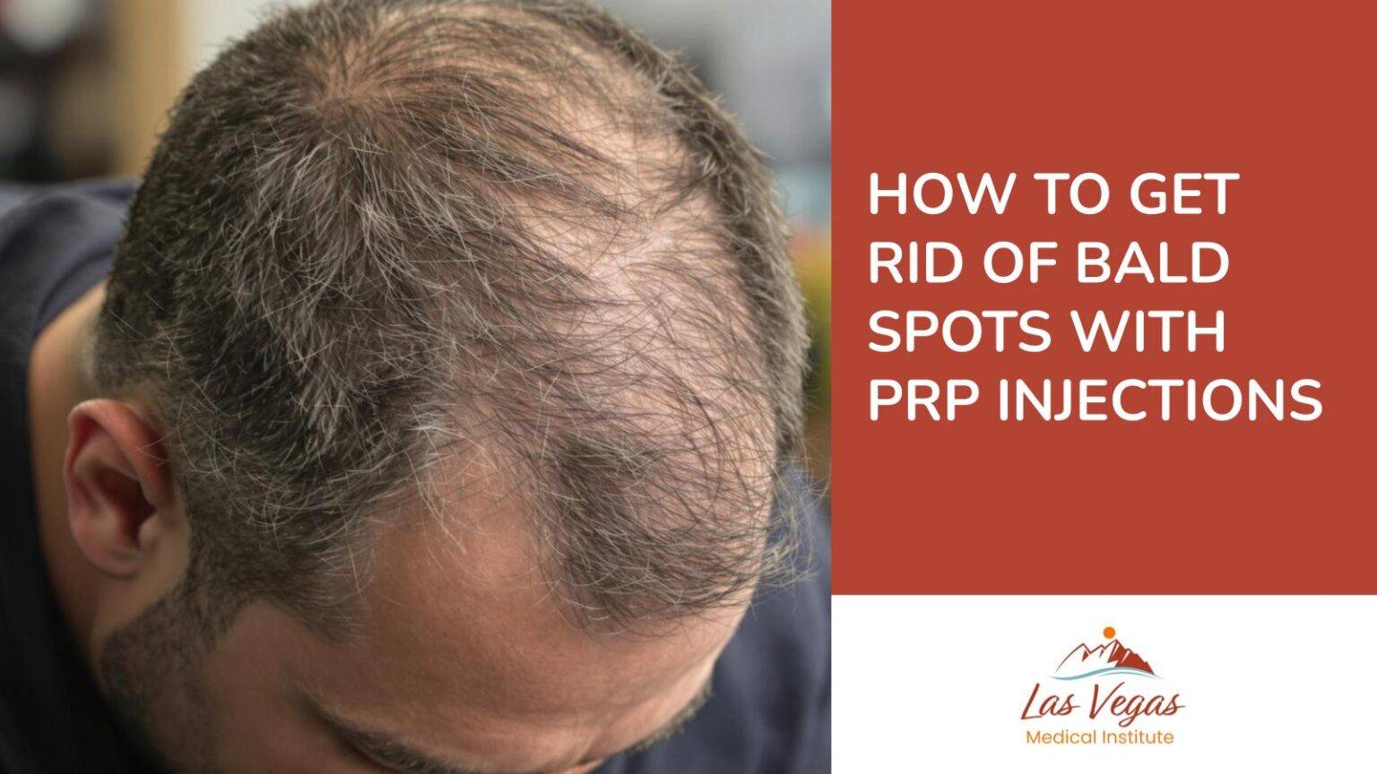 How to Get Rid of Bald Spots With PRP Injections - Las Vegas Medical ...