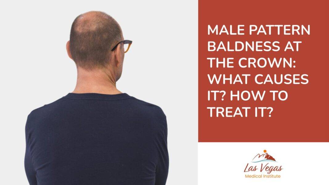 Male Pattern Baldness at the Crown: What Causes it? How to Treat it ...