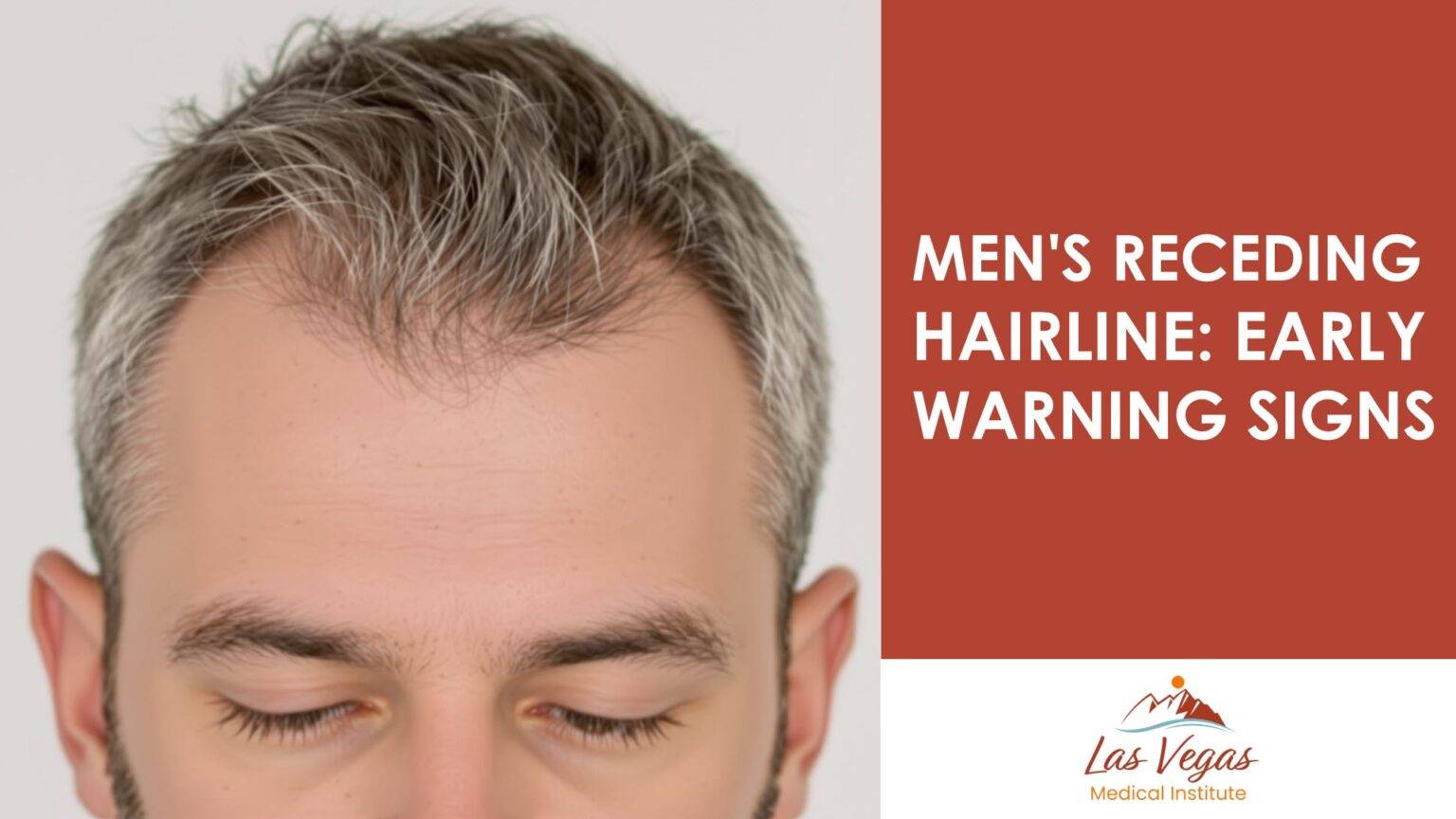 Men's Receding Hairline: Early Warning Signs - Las Vegas Medical ...